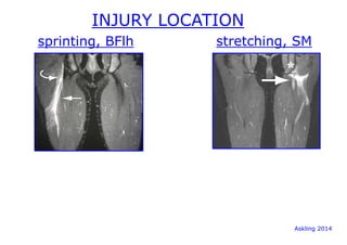 Carl Askling - Sprinting-type vs stretching-type of acute hamstring ...