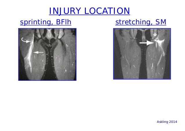 Carl Askling - Sprinting-type vs stretching-type of acute hamstring i…