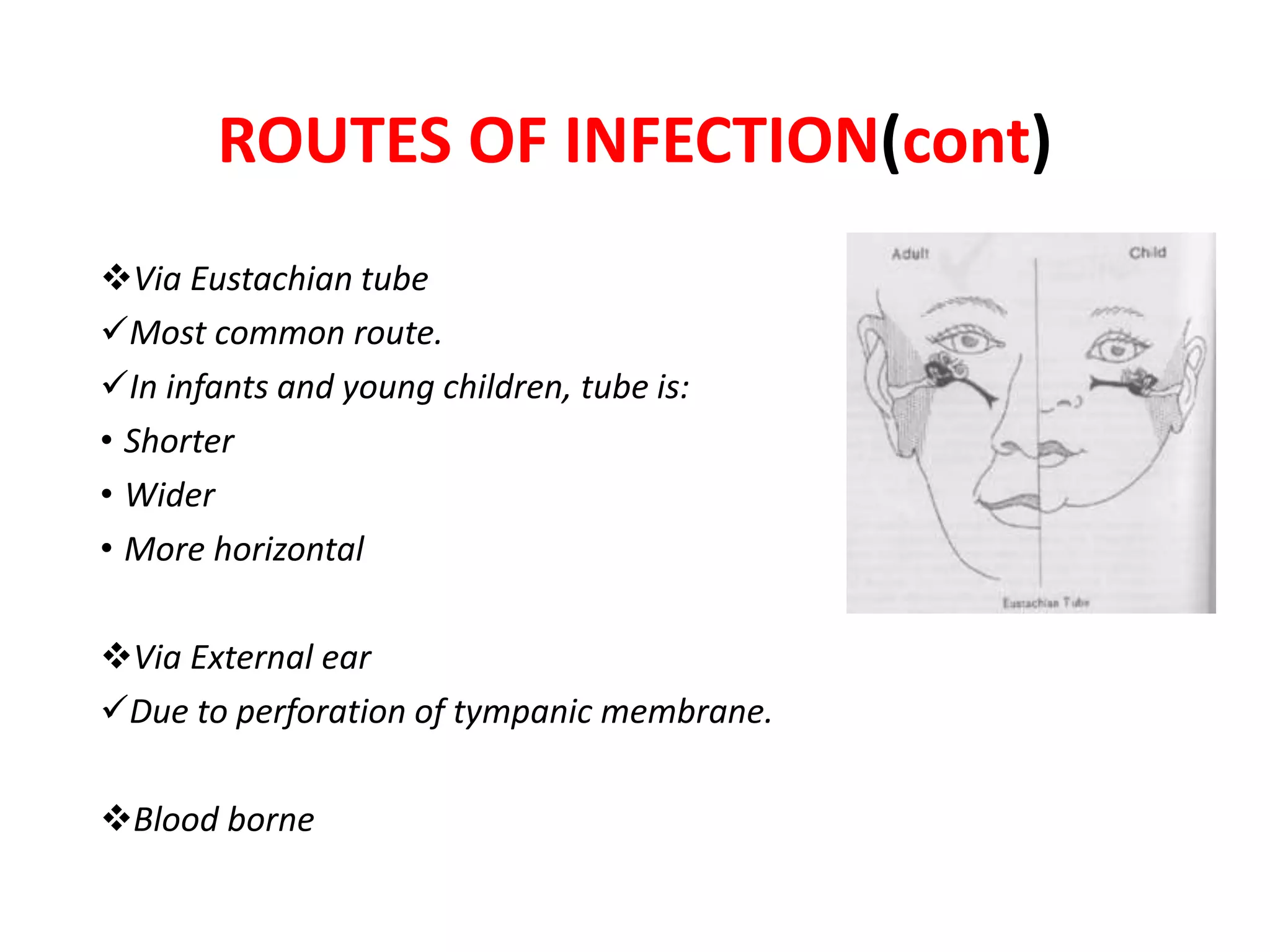 ACUTE SUPPURATIVE OTITIS MEDIA | PPTX
