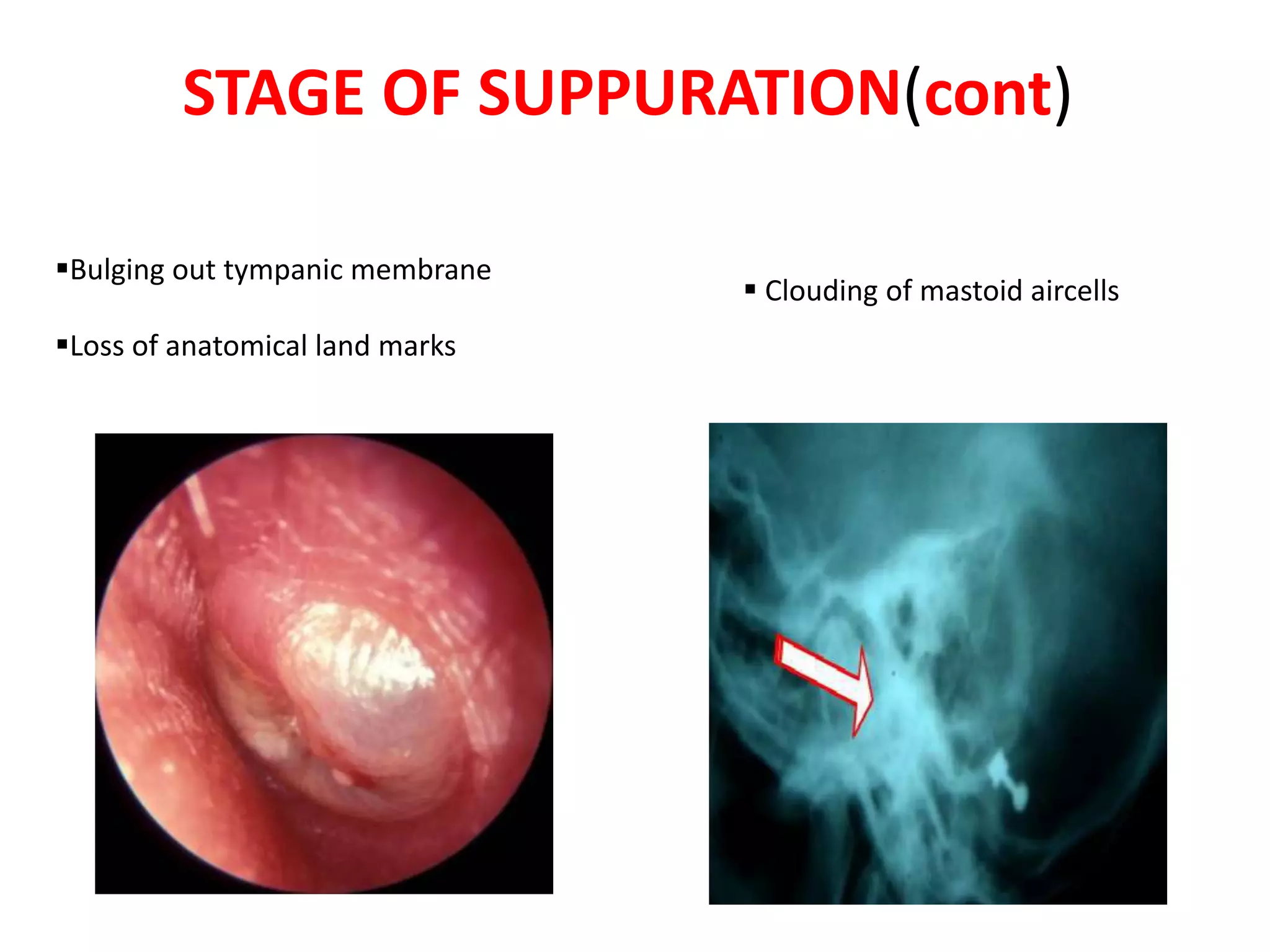 ACUTE SUPPURATIVE OTITIS MEDIA | PPTX