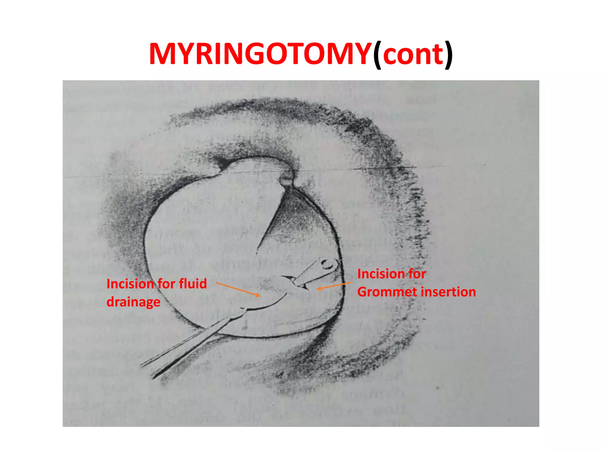 ACUTE SUPPURATIVE OTITIS MEDIA | PPTX
