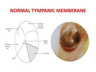 ACUTE SUPPURATIVE OTITIS MEDIA | PPTX