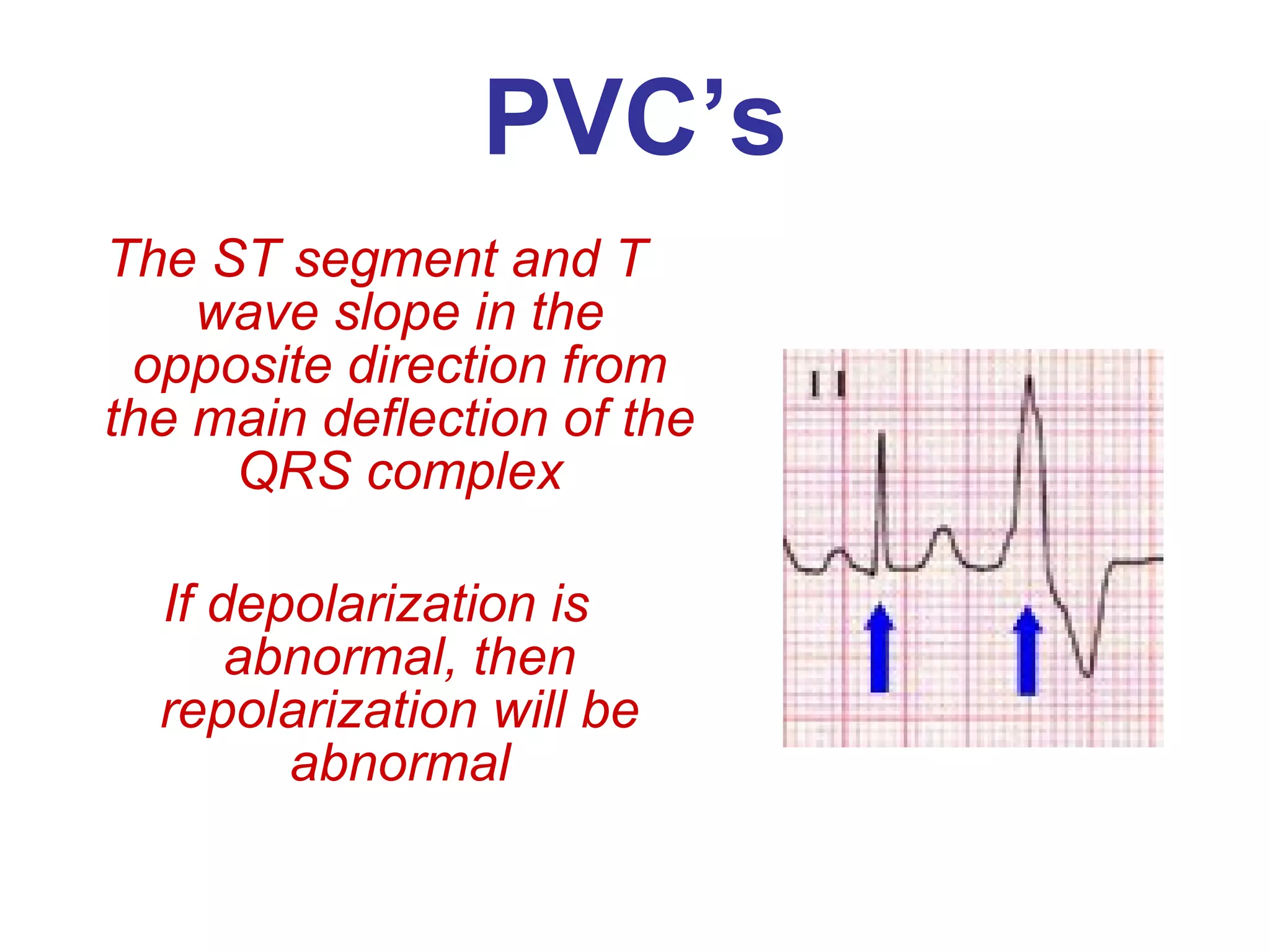 Ventricular Rhythms - BMH/Tele | PPT