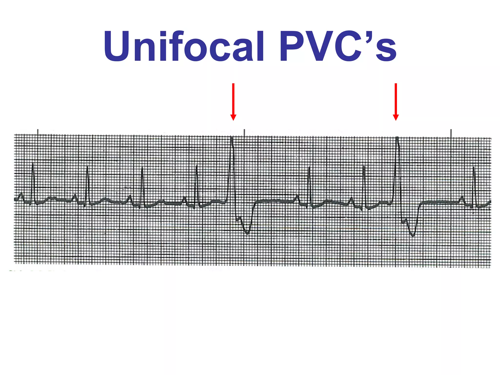 Ventricular Rhythms - BMH/Tele | PPT
