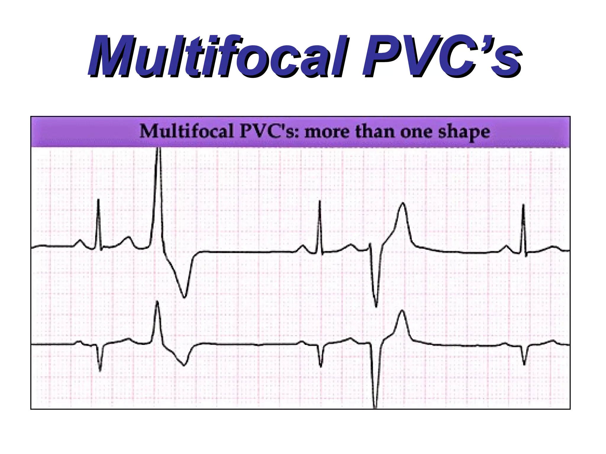 Ventricular Rhythms - BMH/Tele | PPT