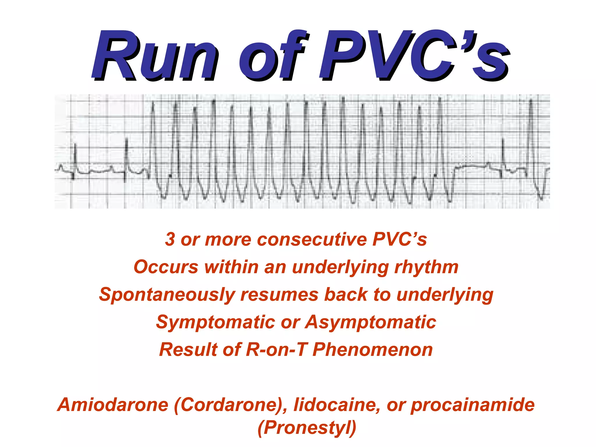 Ventricular Rhythms - BMH/Tele | PPT