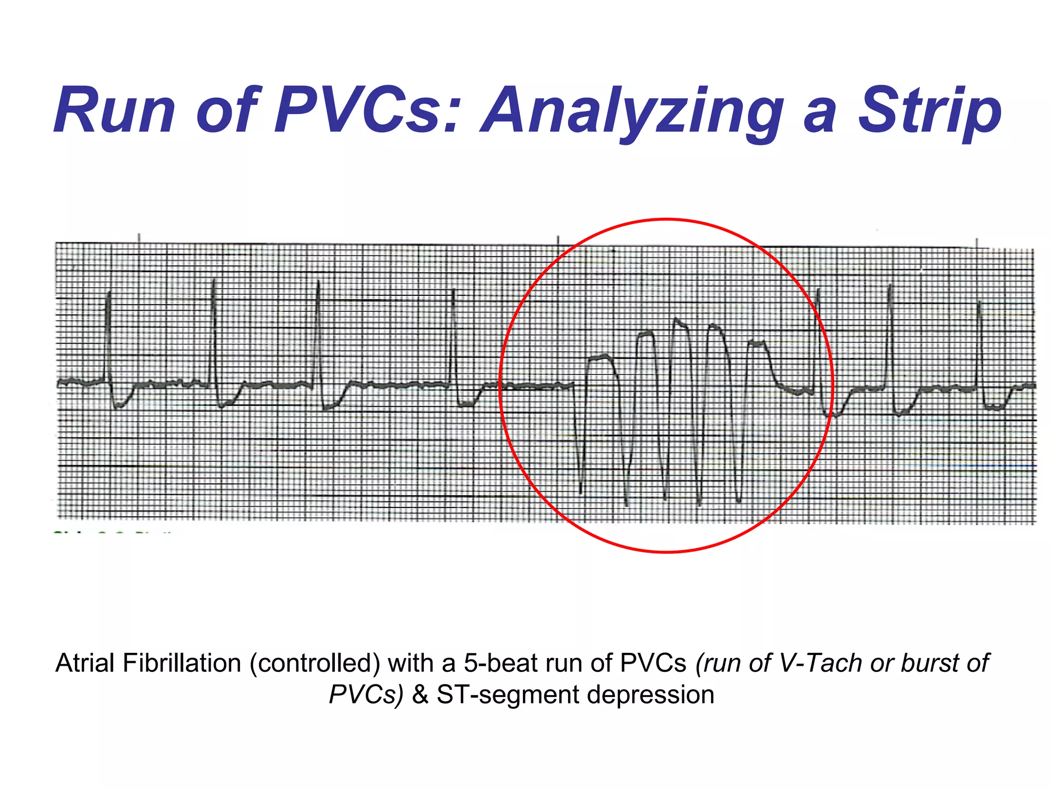 Ventricular Rhythms - BMH/Tele | PPT