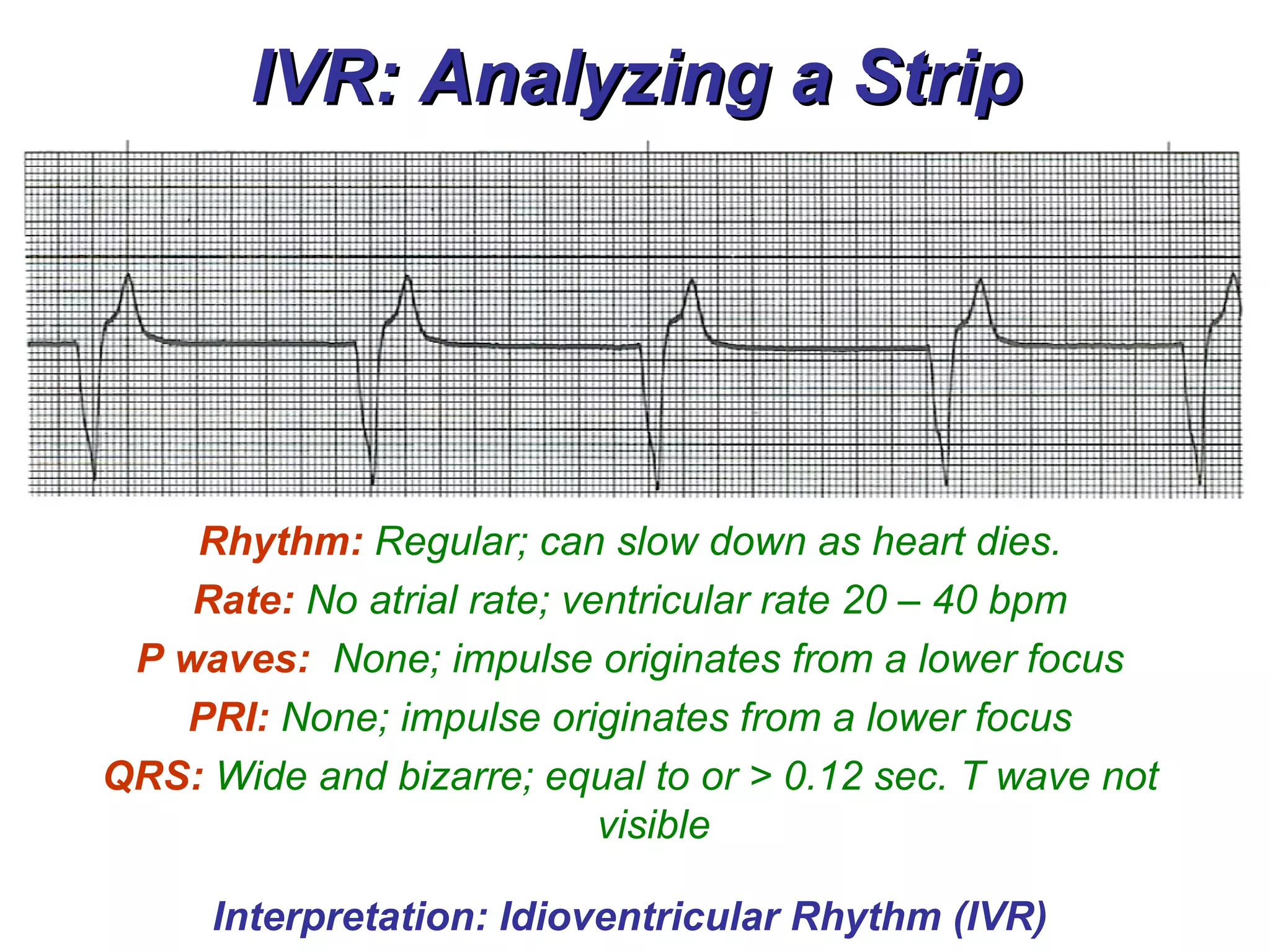Ventricular Rhythms - BMH/Tele | PPT