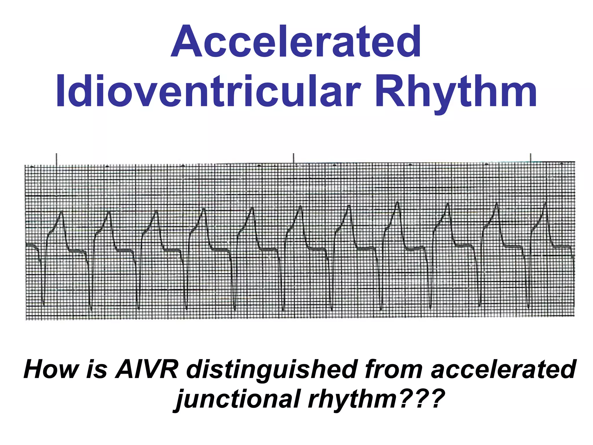 Ventricular Rhythms - BMH/Tele | PPT
