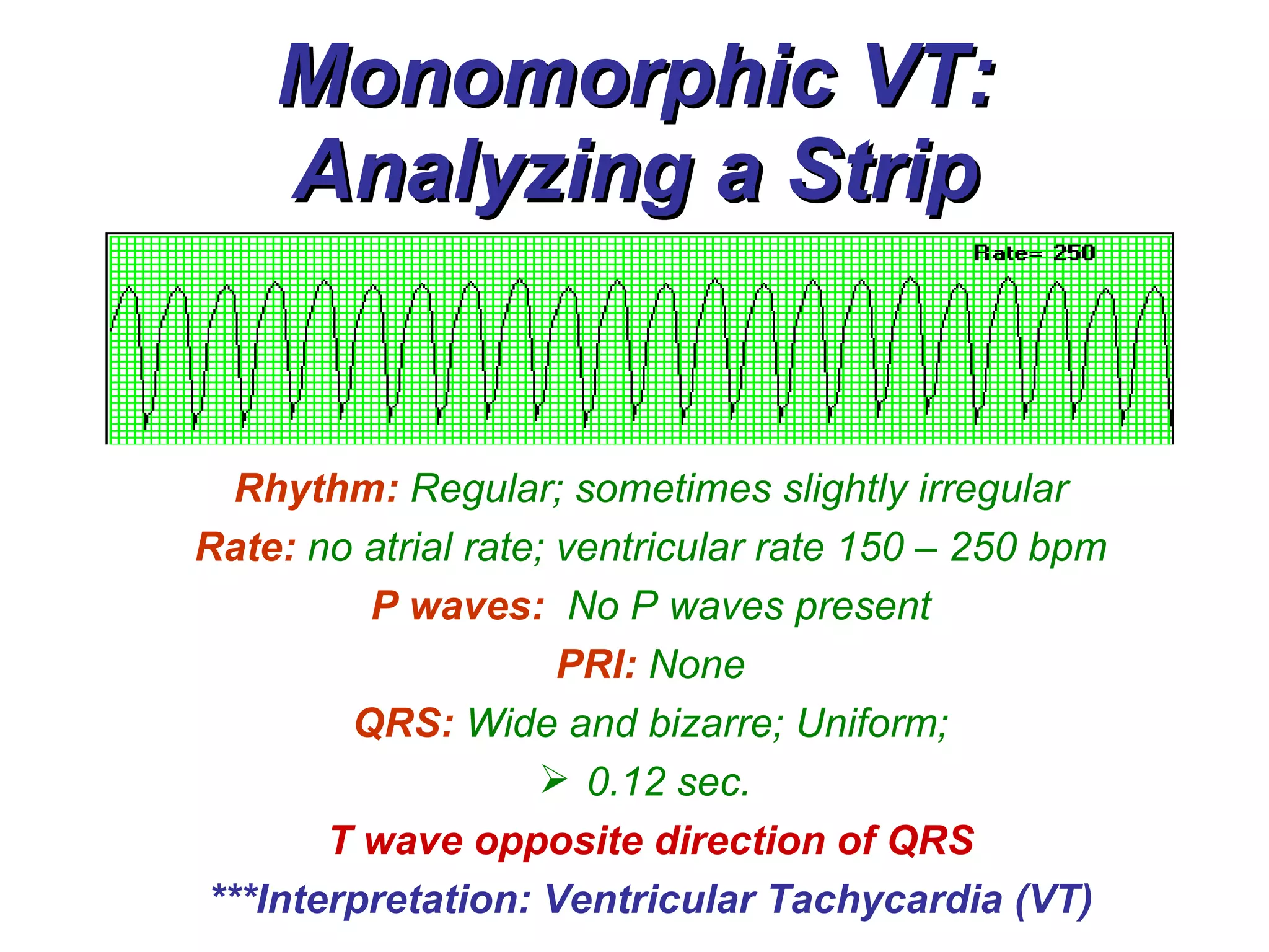 Ventricular Rhythms - BMH/Tele | PPT
