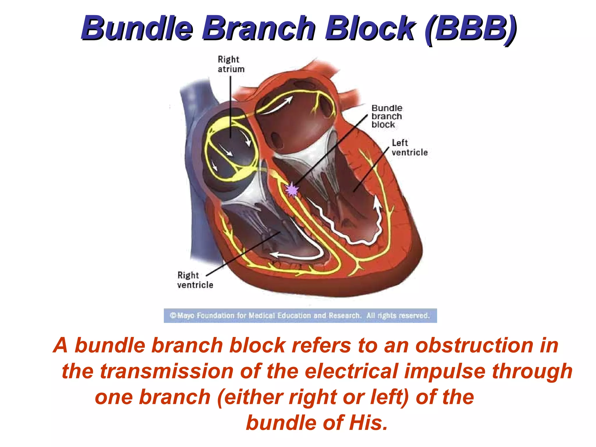 Ventricular Rhythms - BMH/Tele | PPT