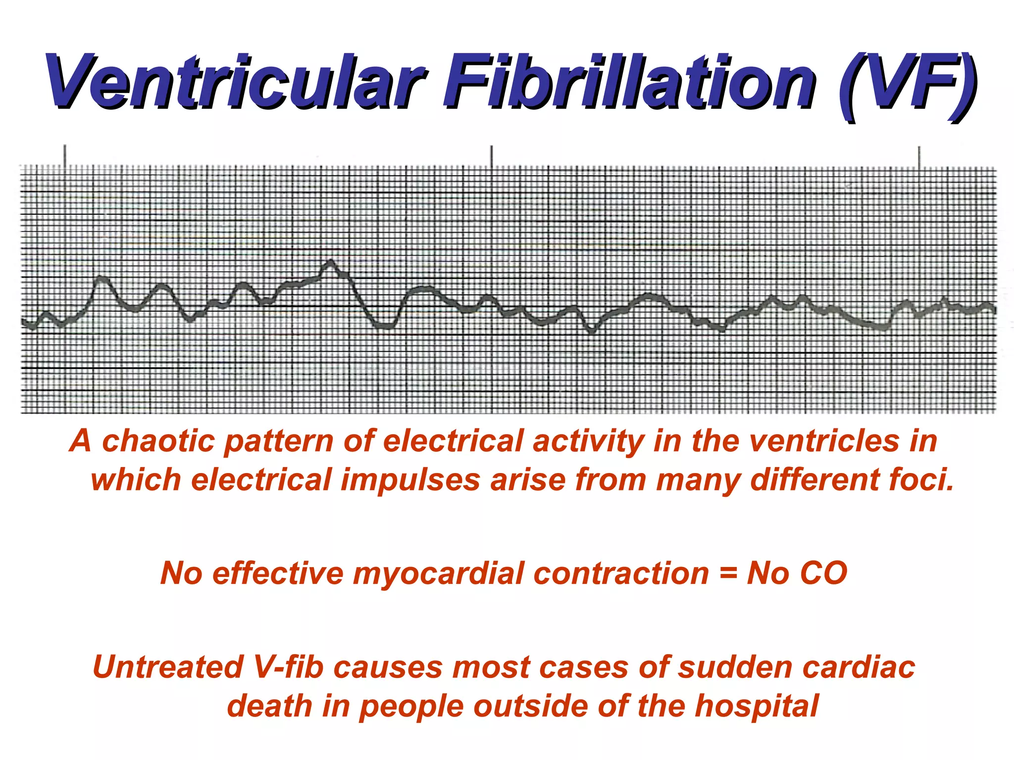 Ventricular Rhythms - BMH/Tele | PPT