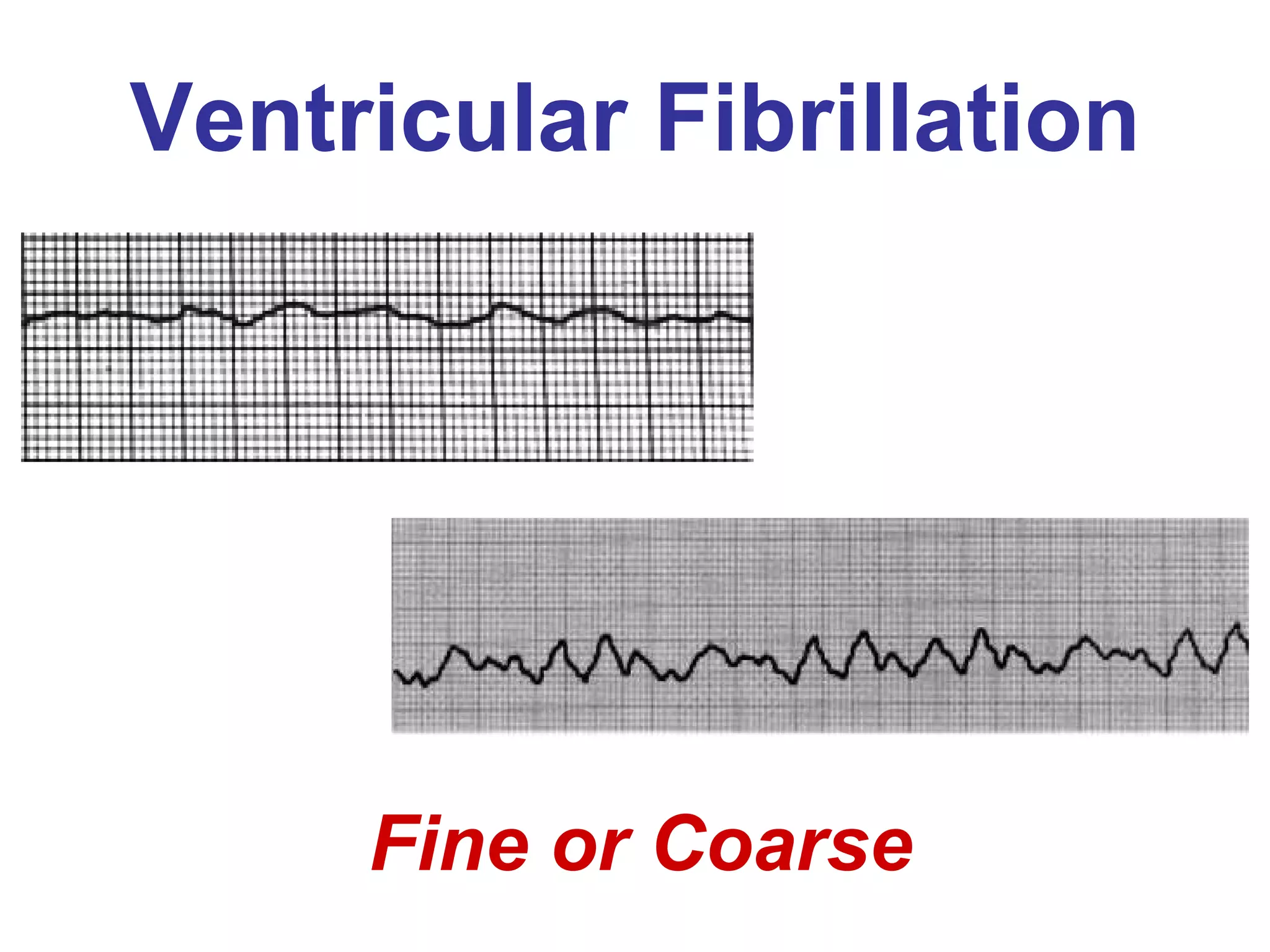 Ventricular Rhythms - BMH/Tele | PPT