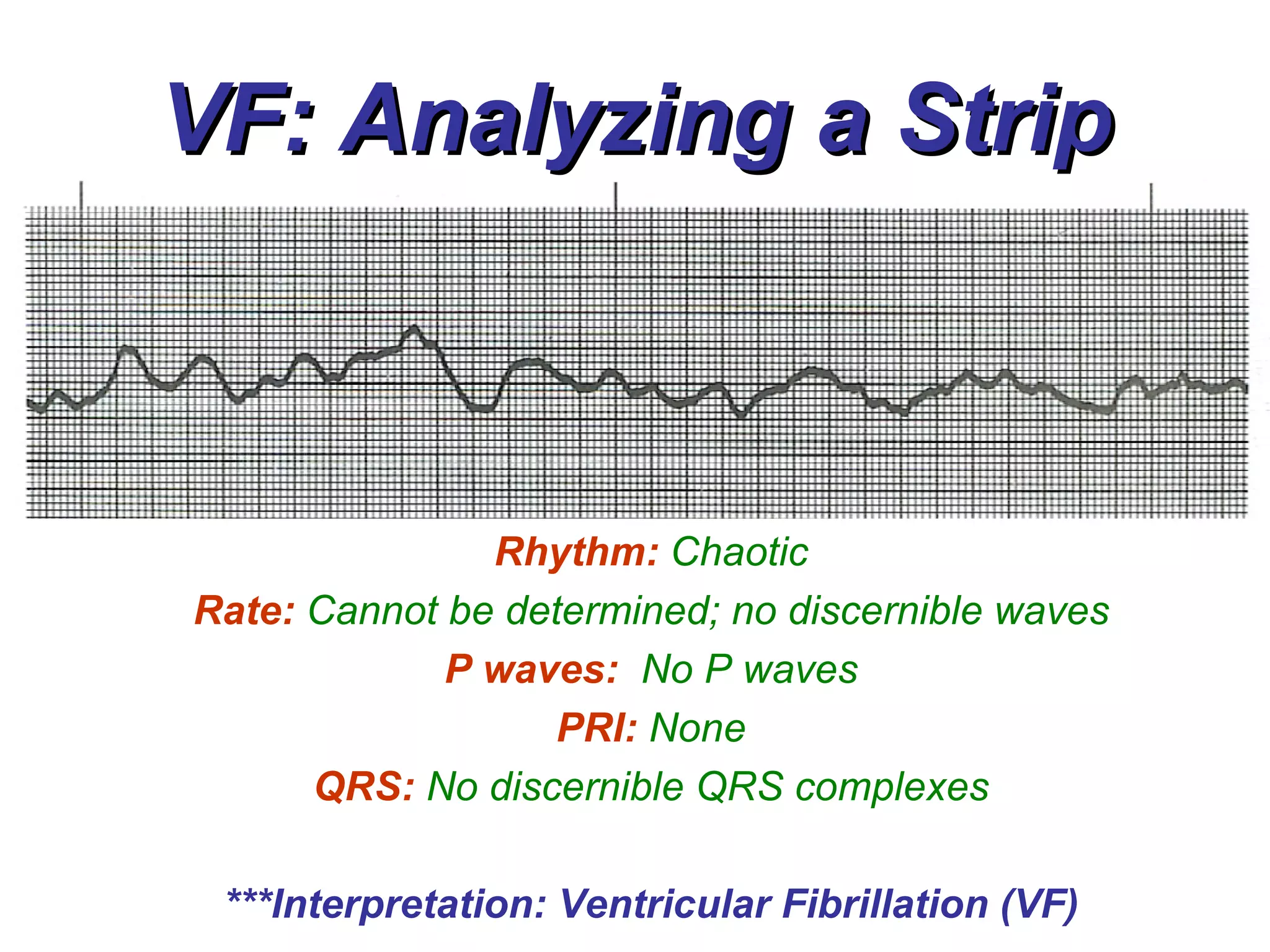 Ventricular Rhythms - BMH/Tele | PPT