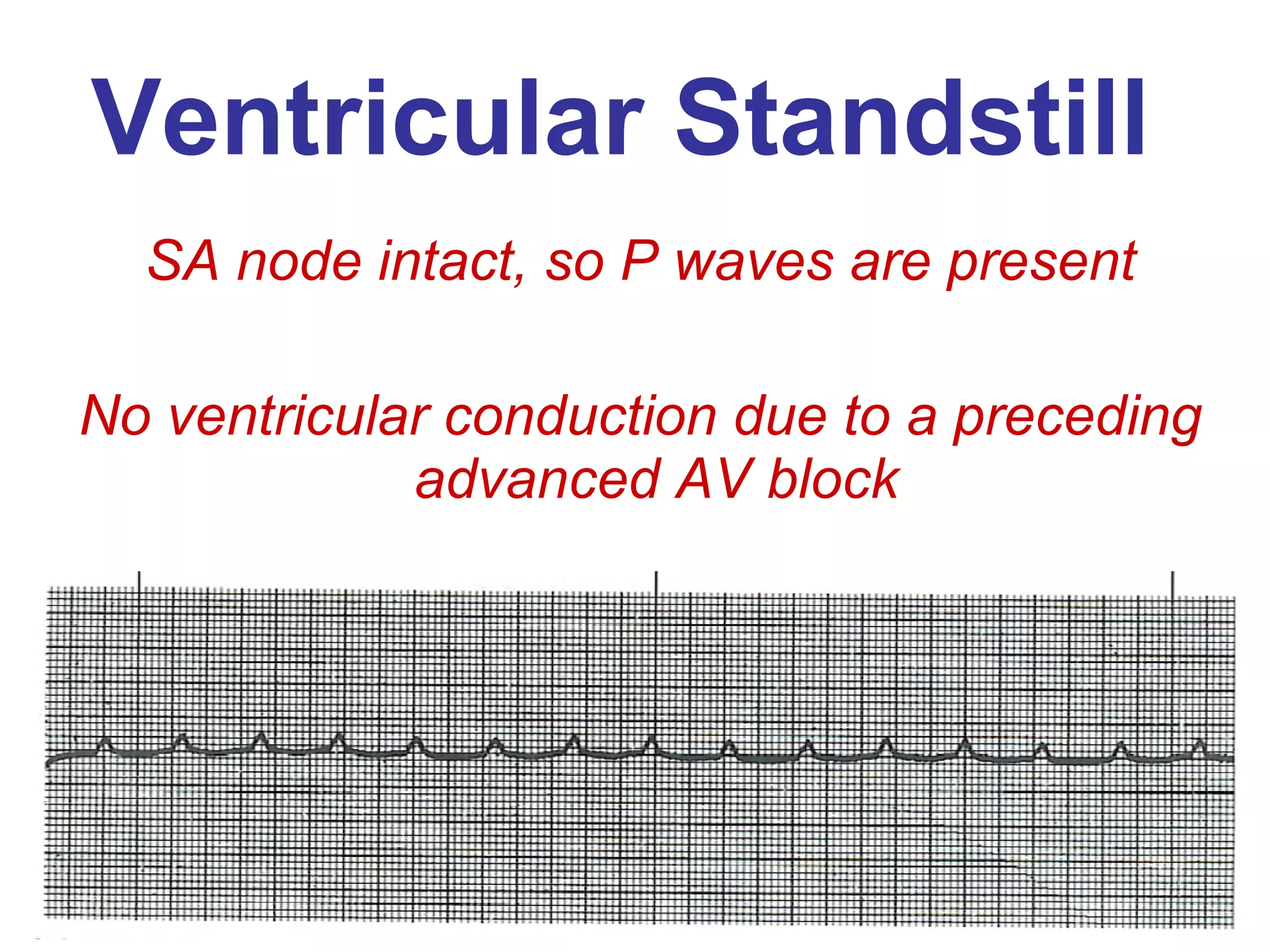 Ventricular Rhythms - BMH/Tele | PPT