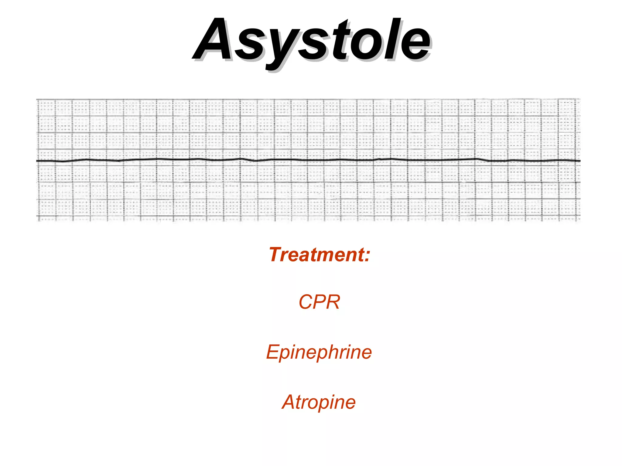 Ventricular Rhythms - BMH/Tele | PPT