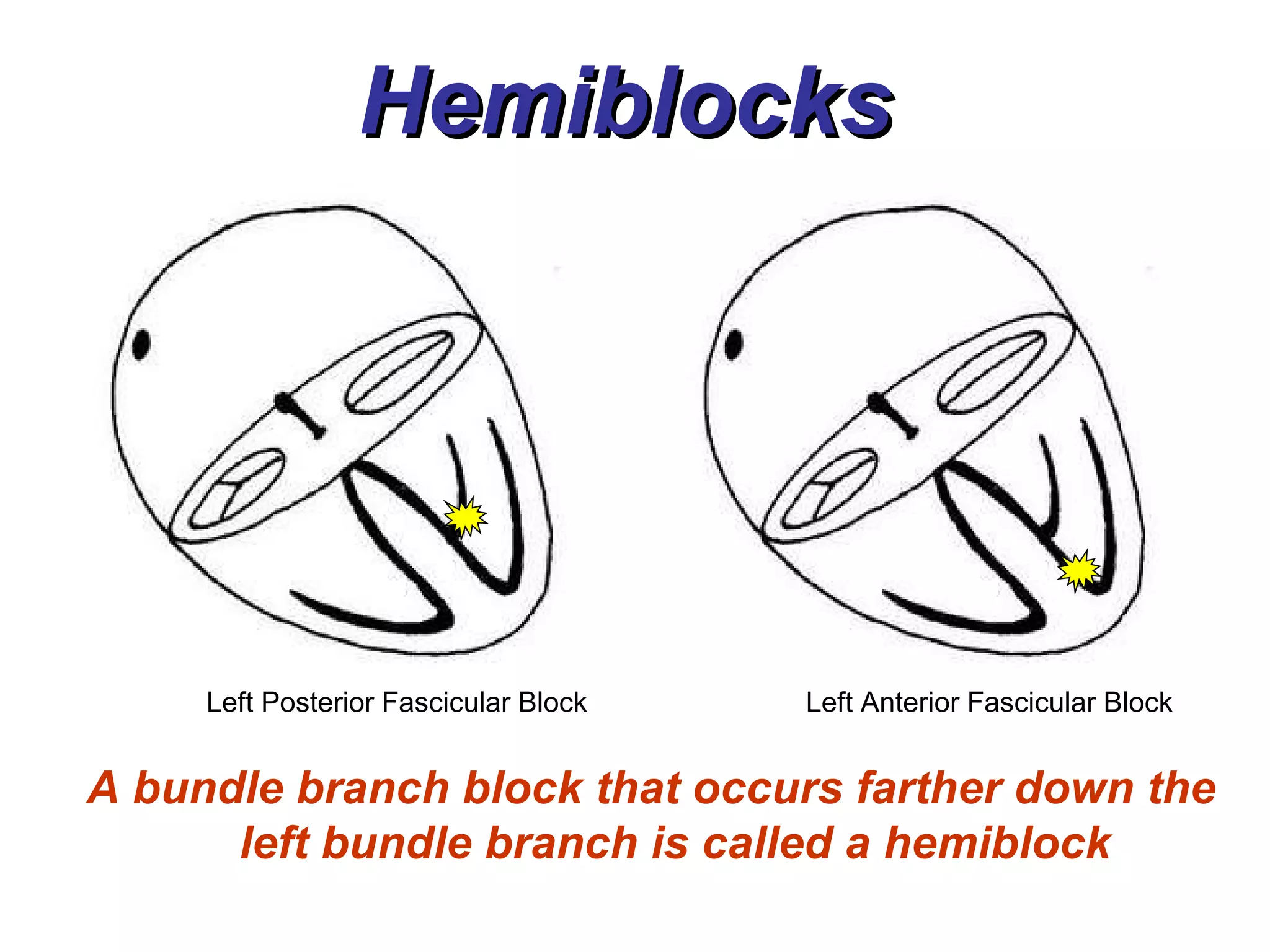 Ventricular Rhythms - BMH/Tele | PPT