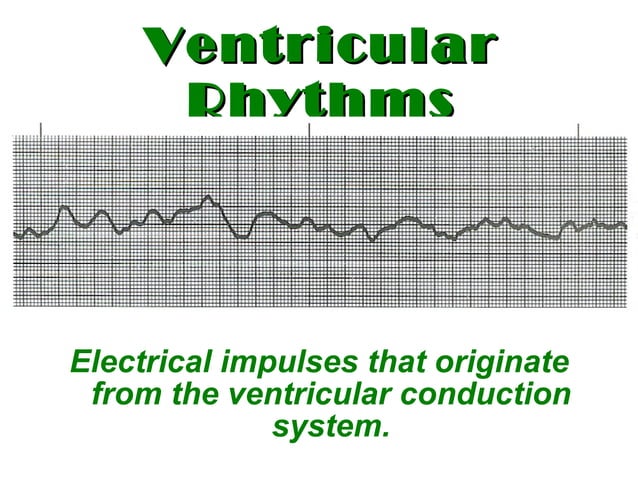 Ventricular Rhythms - BMH/Tele | PPT | Heart and Cardiovascular ...