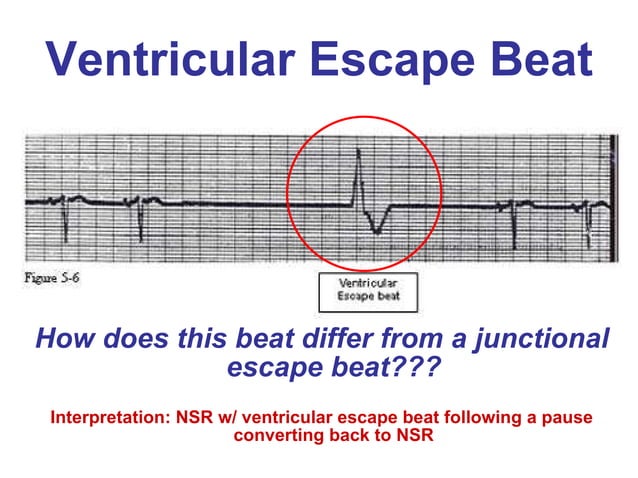Ventricular Rhythms - BMH/Tele | PPT | Heart and Cardiovascular ...