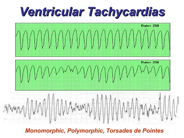 Ventricular Rhythms - BMH/Tele | PPT | Heart and Cardiovascular ...