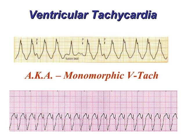 Ventricular Rhythms - BMH/Tele | PPT | Heart and Cardiovascular ...