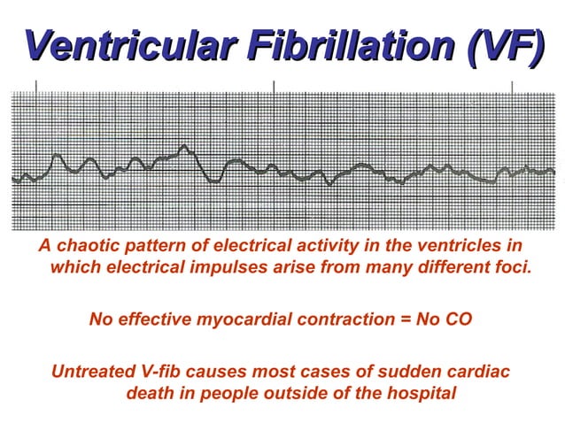 Ventricular Rhythms - BMH/Tele | PPT | Heart and Cardiovascular ...