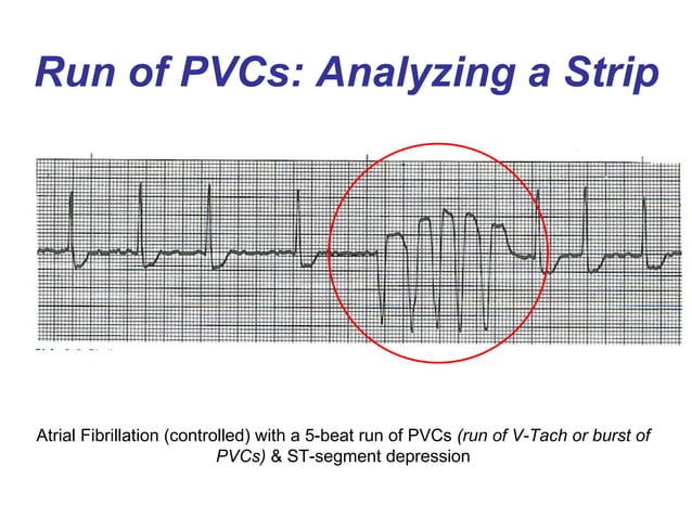 Ventricular Rhythms - BMH/Tele