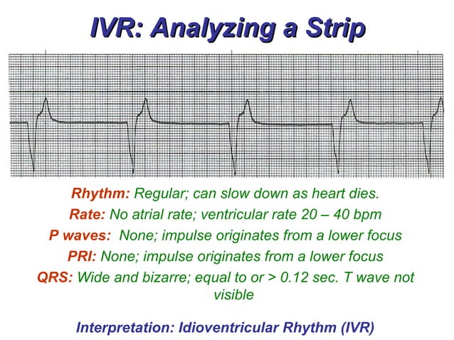 Ventricular Rhythms - BMH/Tele | PPT