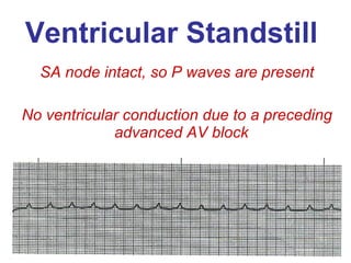 Ventricular Standstill Strips