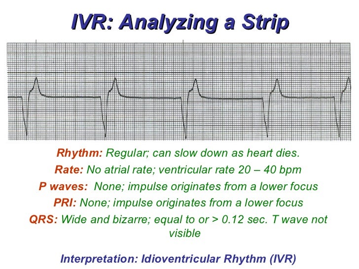 Ventricular Rhythms - BMH/Tele