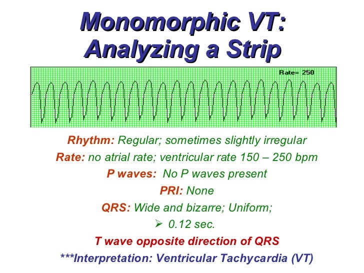Ventricular Rhythms - BMH/Tele