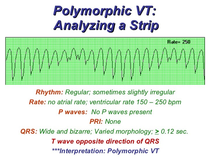 Ventricular Rhythms - BMH/Tele