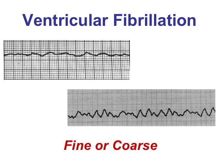 Fine Ventricular Fibrillation Vs Coarse Ventricular Fibrillation