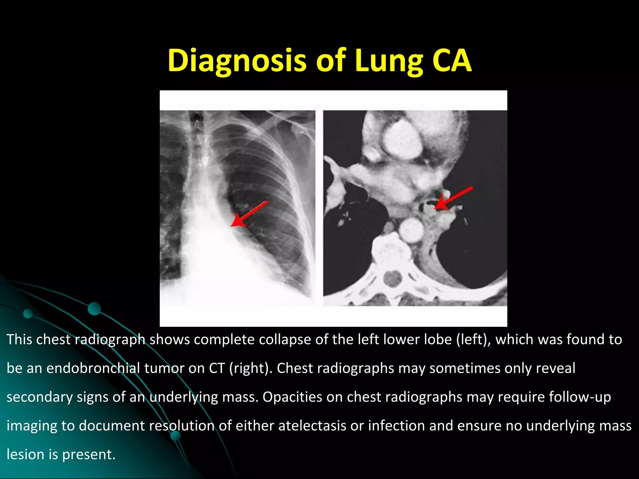 6 Basics of Lung CA.pptx