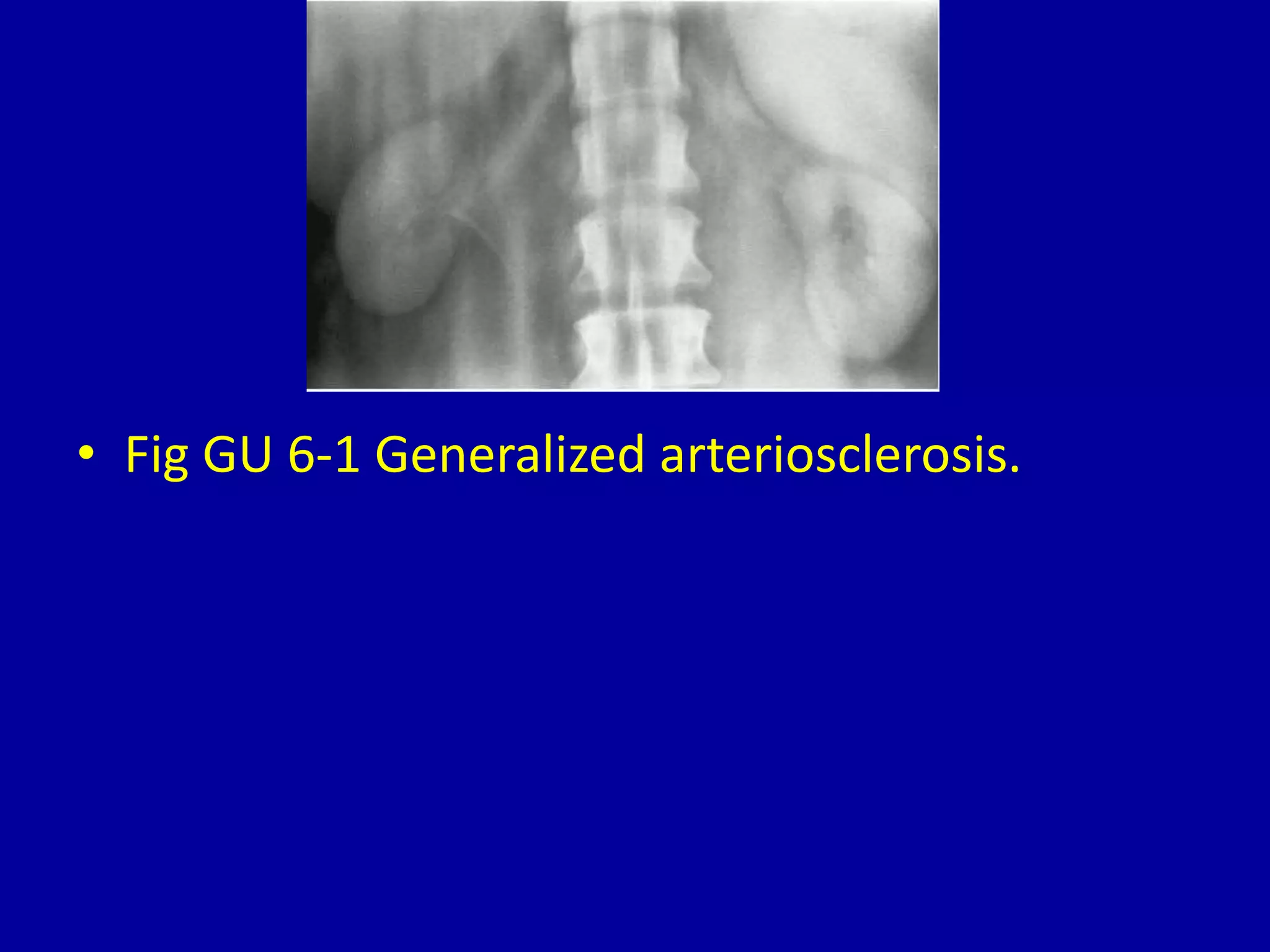 6 bilateral small, smooth kidneys | PPTX