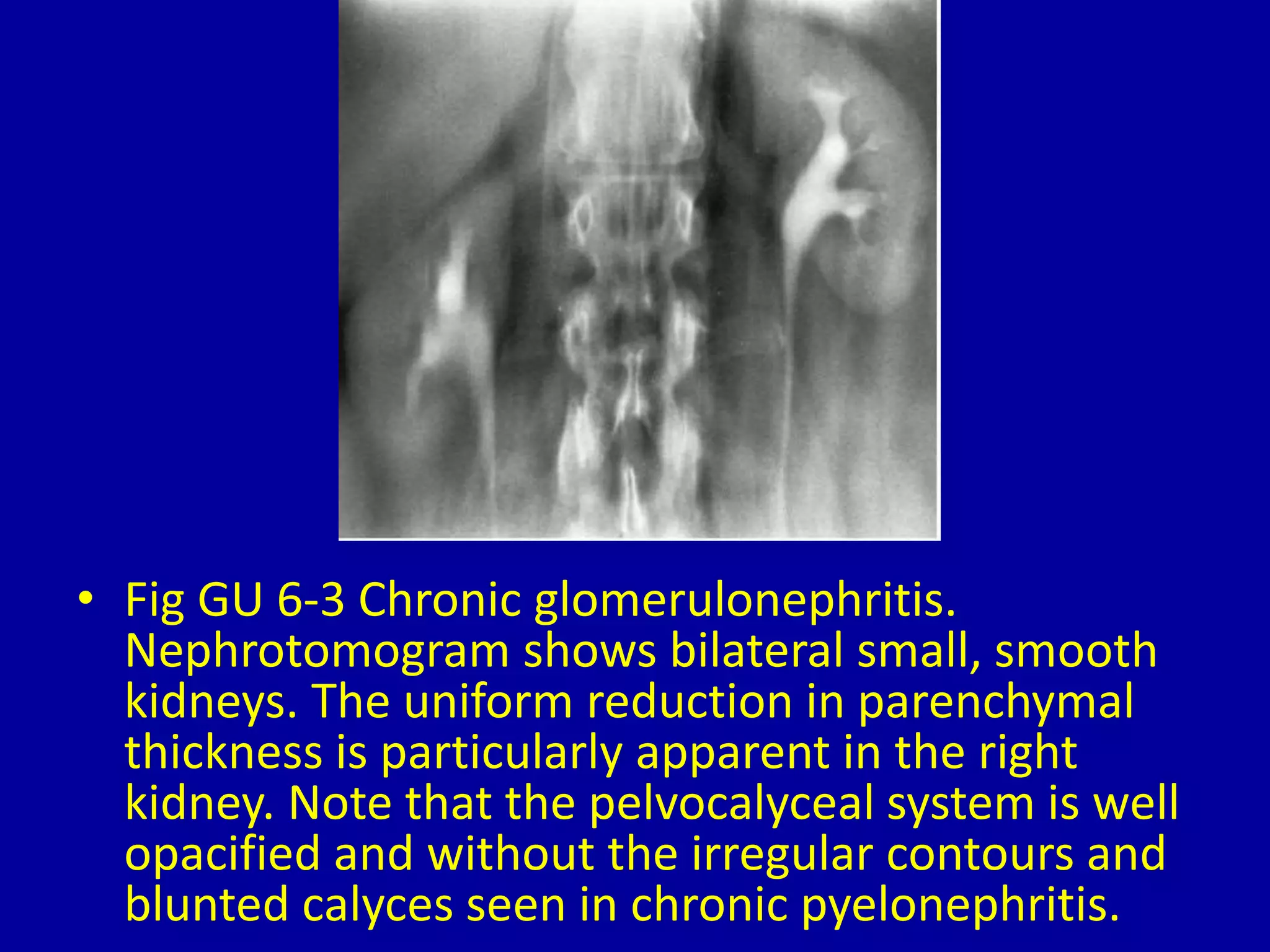 6 bilateral small, smooth kidneys | PPTX