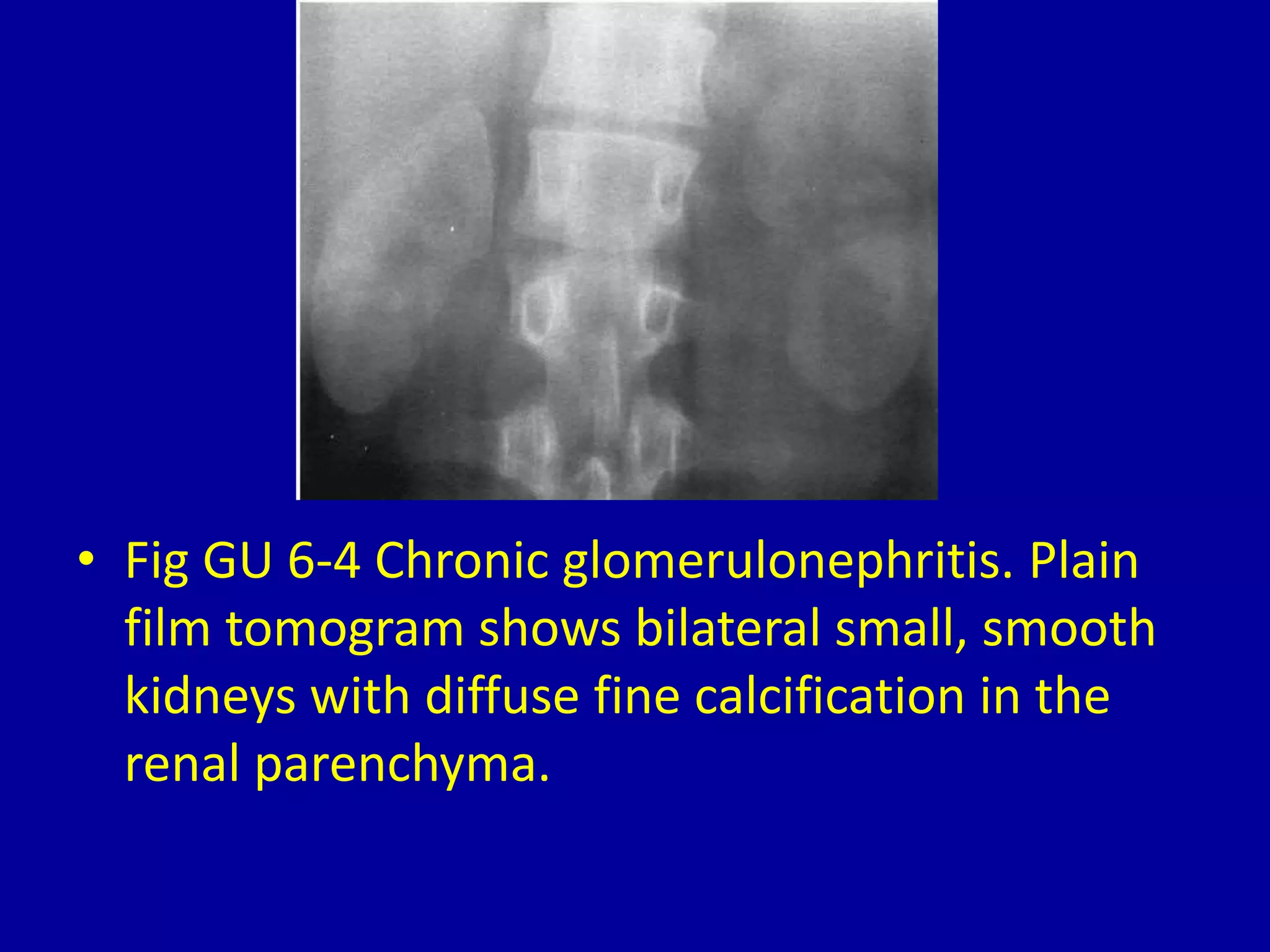 6 bilateral small, smooth kidneys | PPTX