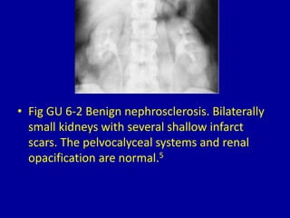 6 bilateral small, smooth kidneys | PPTX