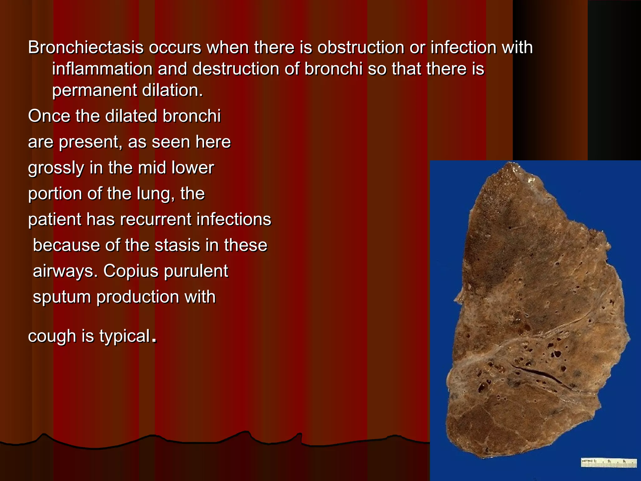 6 bronchiectasis | PPT