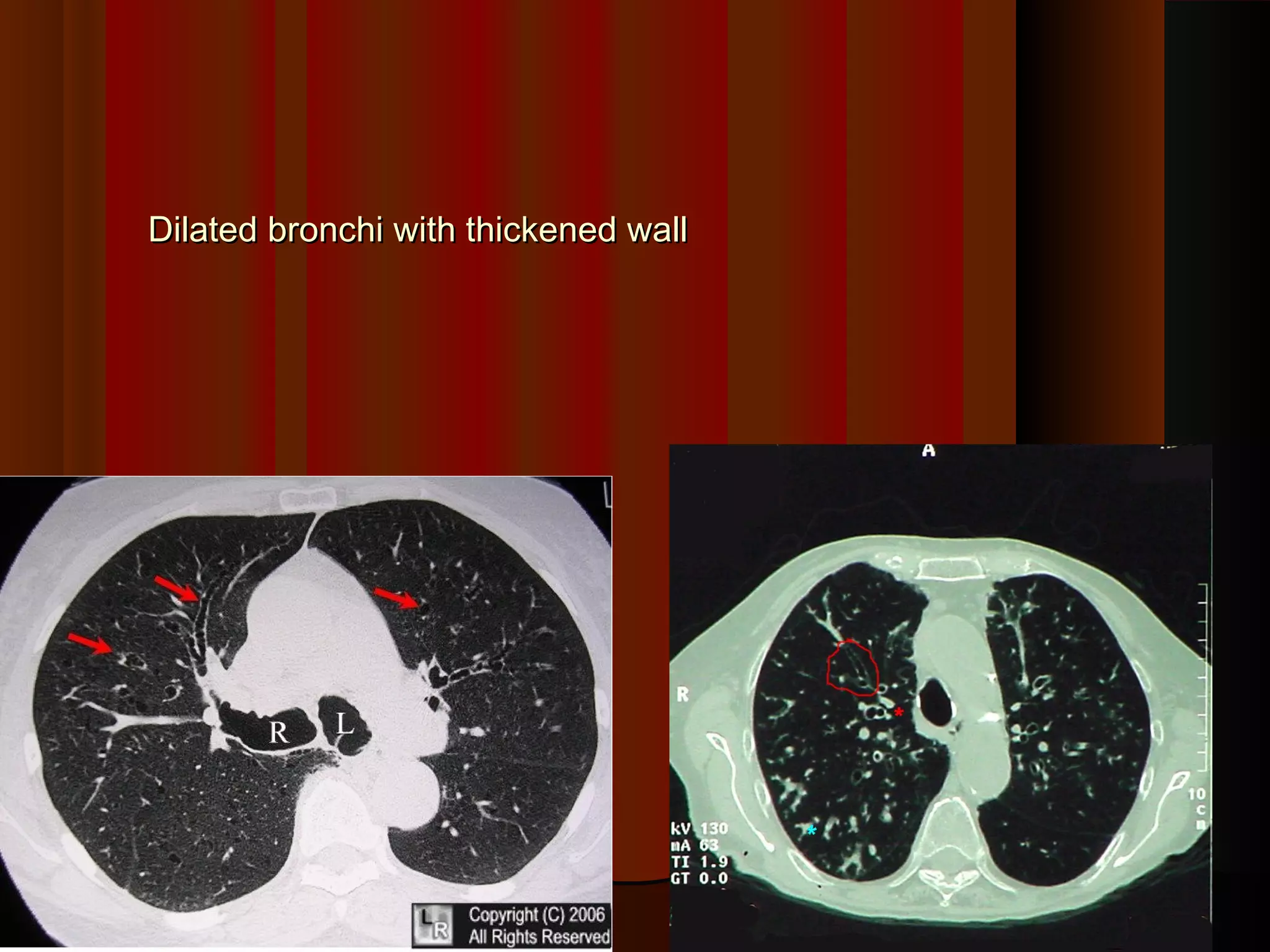 6 bronchiectasis | PPT