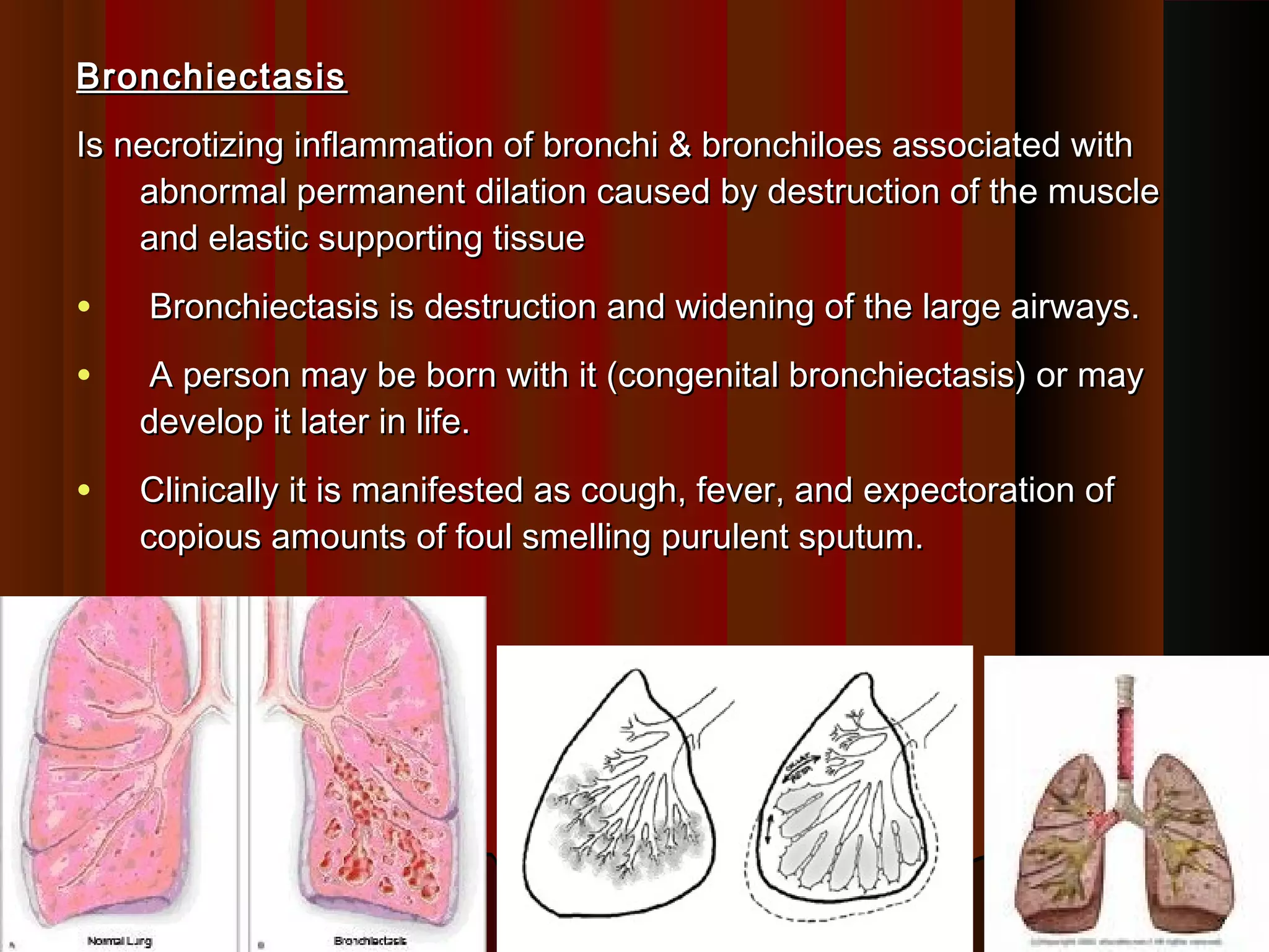 6 bronchiectasis | PPT