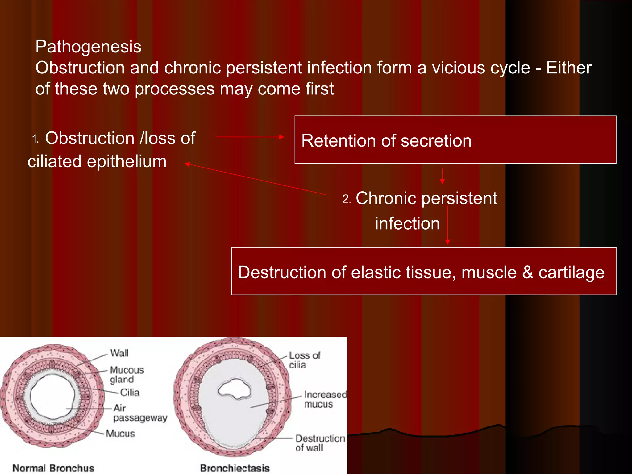 6 bronchiectasis | PPT
