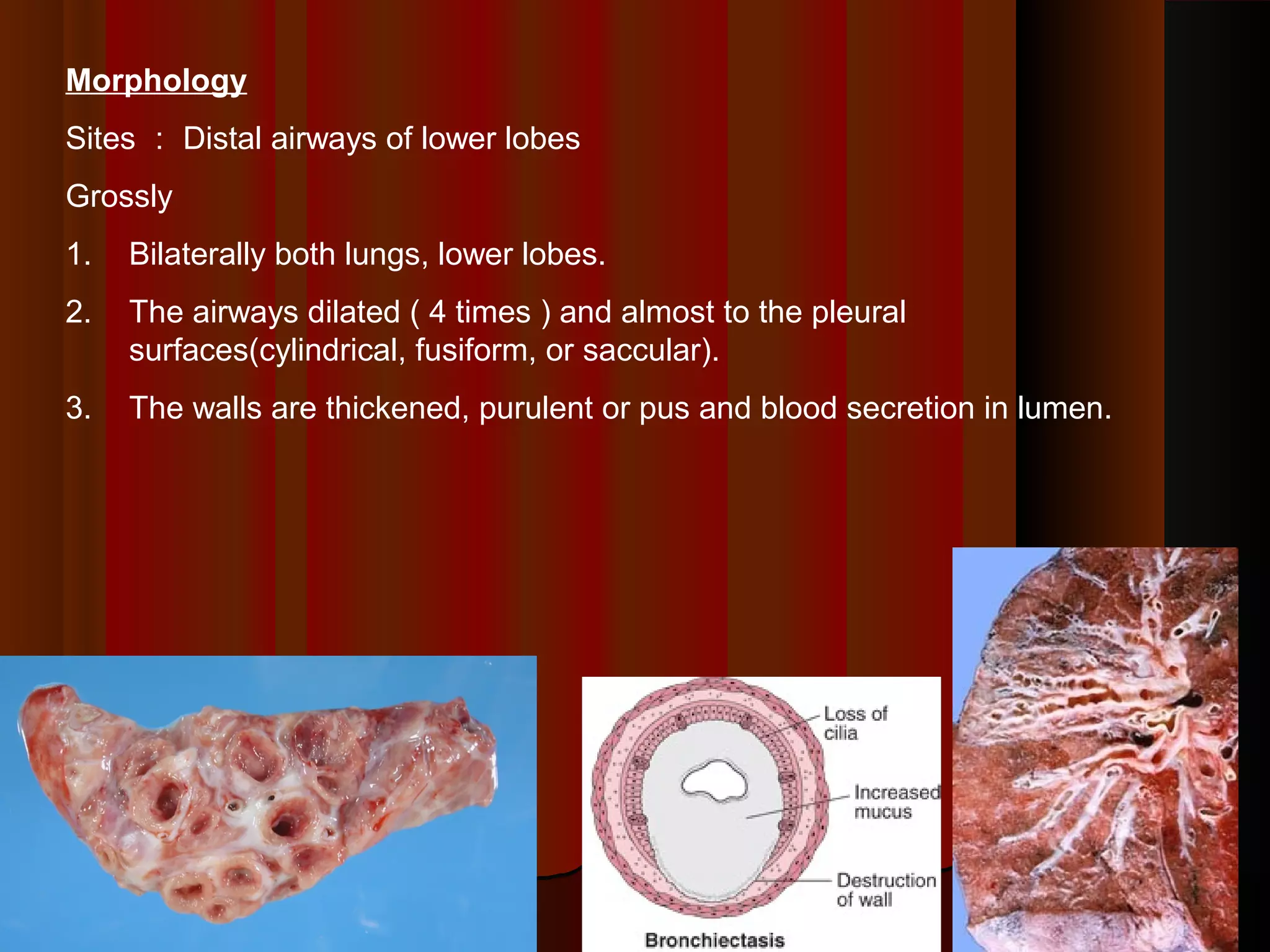 6 bronchiectasis | PPT