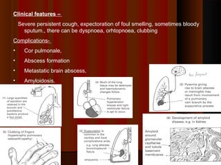 6 bronchiectasis | PPT