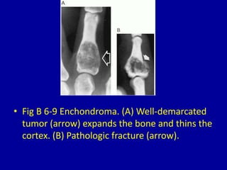 6 bubbly lesions of bone | PPTX