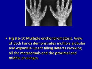 6 bubbly lesions of bone | PPTX