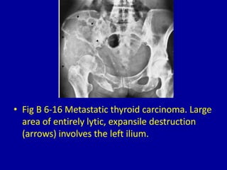6 bubbly lesions of bone | PPTX