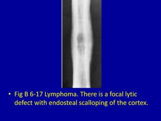 6 bubbly lesions of bone | PPTX