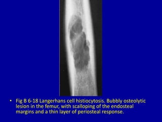 6 bubbly lesions of bone | PPTX