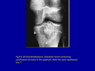 6 bubbly lesions of bone | PPTX